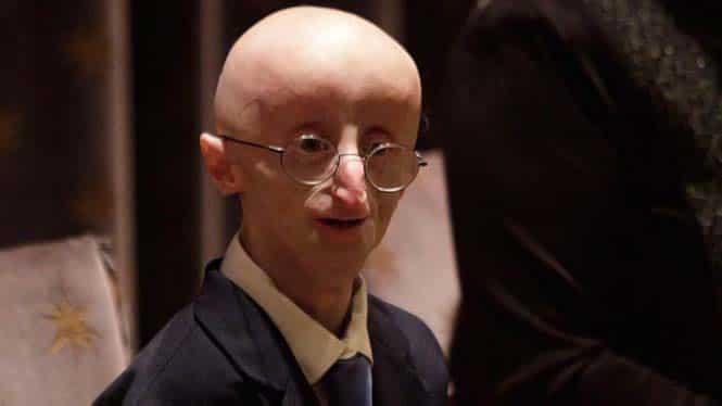 US boy with rare genetic condition that accelerates aging process dies ...