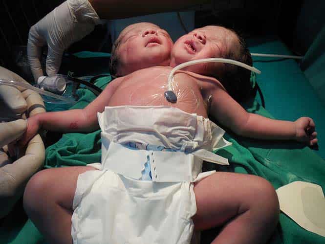 'Very, very rare' conjoined twins delivered at Haryana hospital ...
