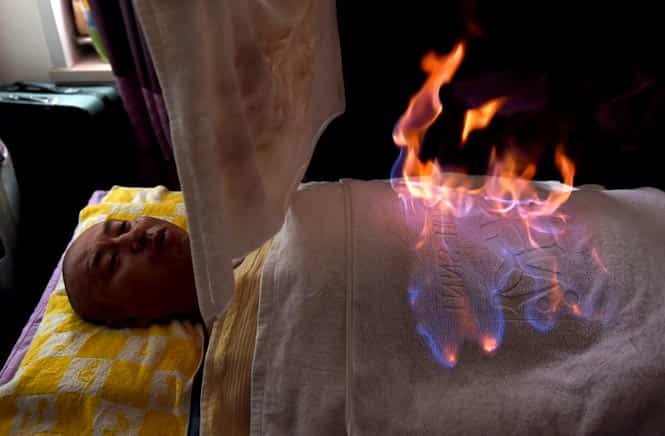 Burn, patient, burn: China's unusual medical therapy | World News