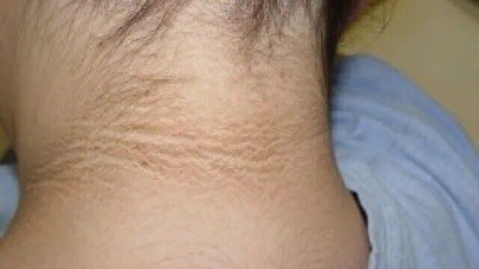 Skin Care Tips: मानेचा काळेपणा ‘या’ ३ घरगुती उपायांनी करा दूर!