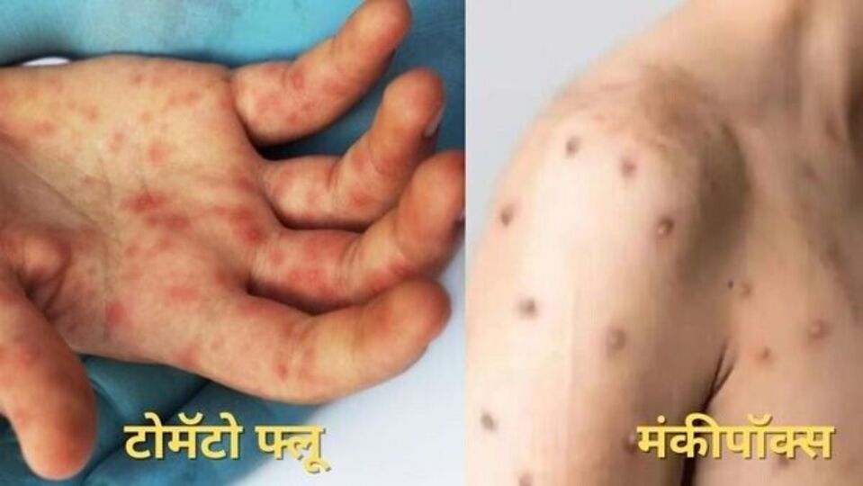 Tomato Flu vs Monkeypox: टोमॅटो फ्लू म्हणजे काय? हा आजार ...