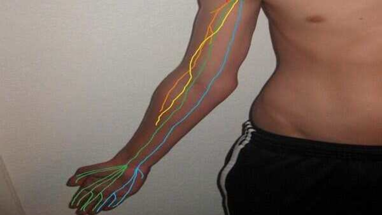Pseudoaneurysm with median nerve injury caused by right radial artery ...