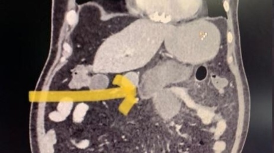 What is intestinal black fungus? 2 rare cases of mucormycosis at Delhi ...