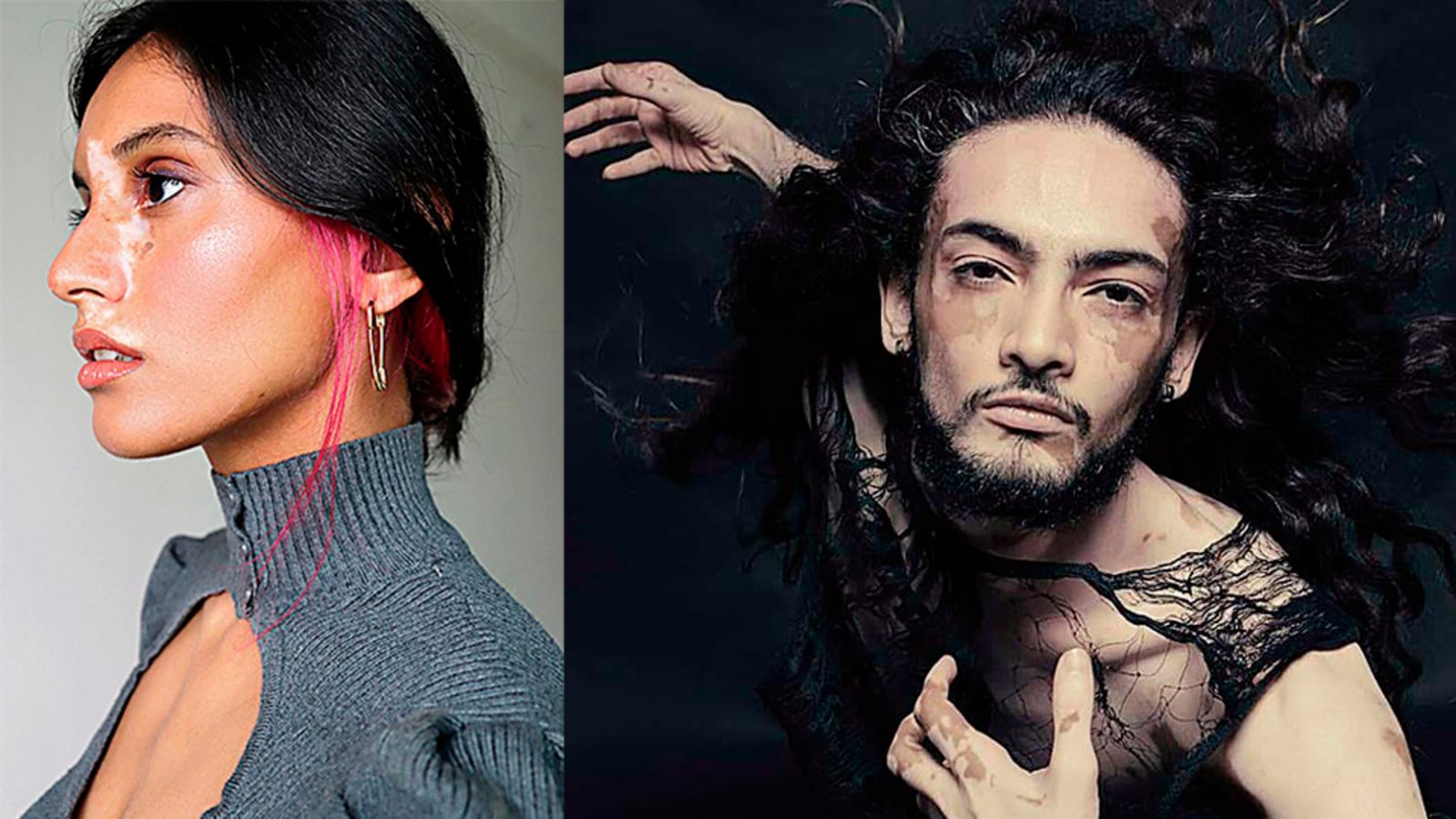 World Vitiligo Day 2021: Living with two skin tones - Hindustan Times