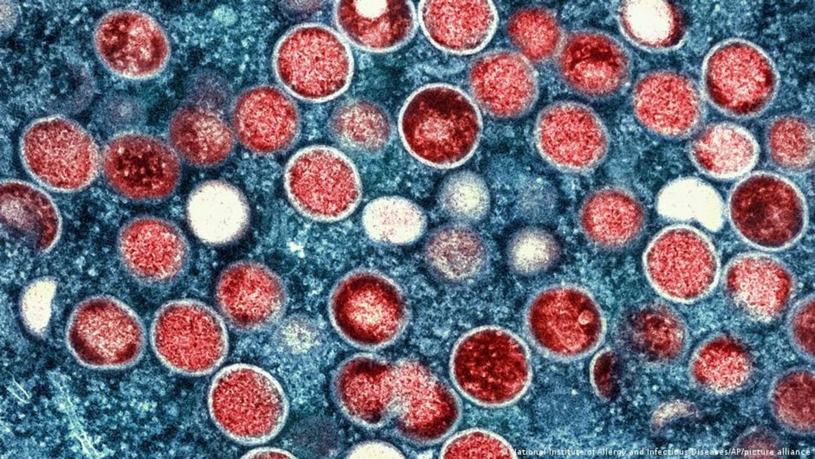 Monkeypox in kids is rare but infections can be serious | Health