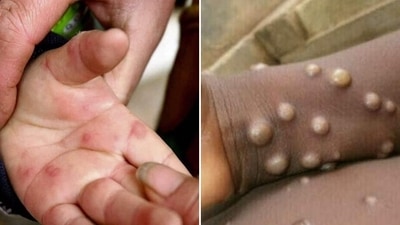 Monkeypox vs tomato flu: Know difference in symptoms from expert | Health