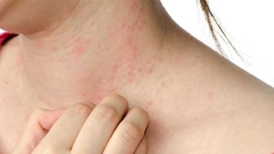 Heat rash and fungal infection in summer? Check out these tips for ...