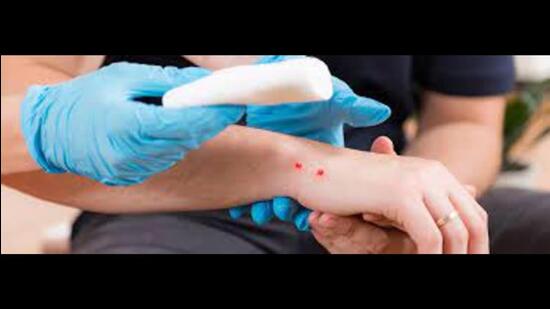 Two die of snakebite | Hindustan Times