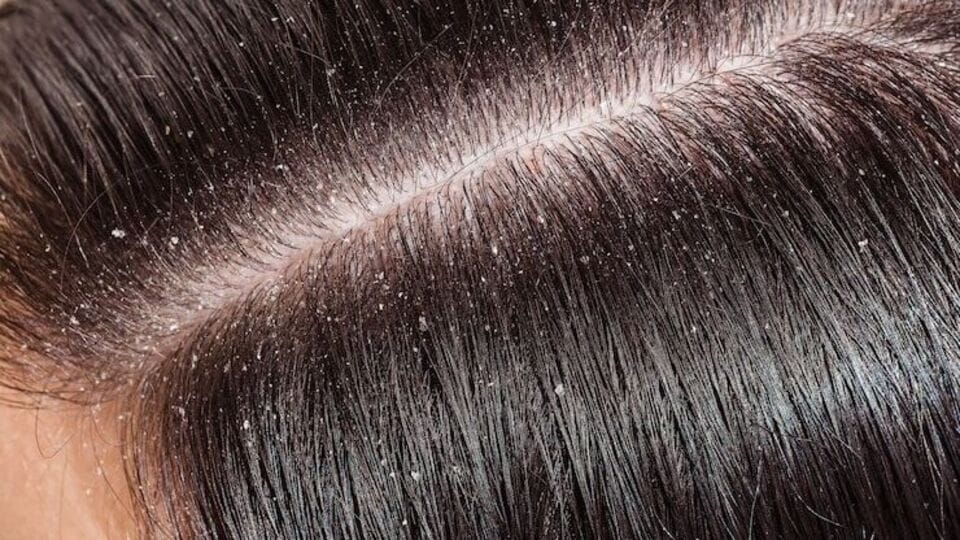 Hair Dandruff: हिवाळ्यात कोंड्याच्या समस्येने तुम्ही हैराण आहात का? हे ...