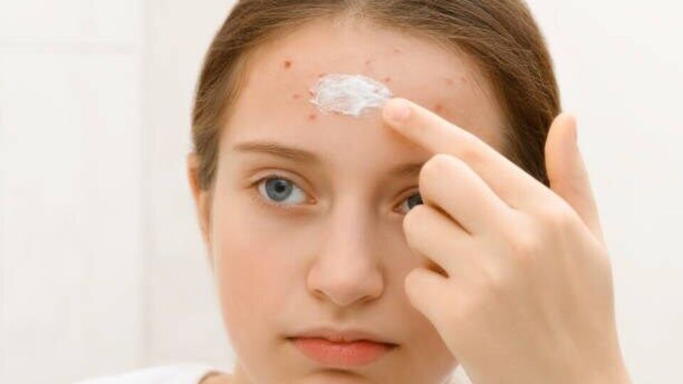 Remedies for Pimples: पावसाळ्यात कपाळावर पिंपल्स येतात? या पद्धतींनी ...