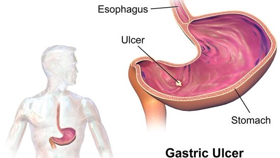 Ulcer Home Remedies: अल्सरच्या समस्येने त्रस्त आहात? घरी सहज करू शकता ...