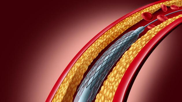 With international stents being withdrawn, Indian manufacturers step up ...