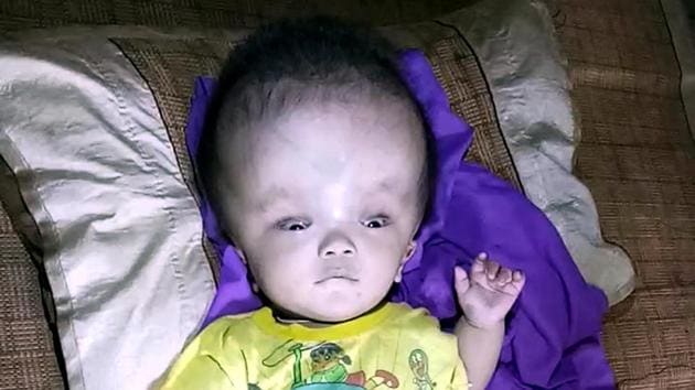 After Tripura girl, Manipur boy suffers from giant head syndrome ...