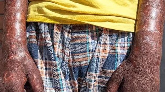 Maharashtra health scare: 14,000 leprosy cases in two years | Mumbai ...