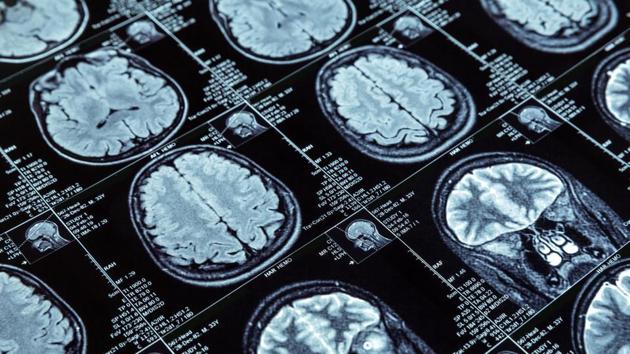 Brain scans may help detect psychiatric disorders | Health