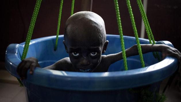 Photos: Malnutrition stalks children in tattered Central African ...