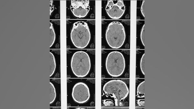 Researchers develop new drug-delivery system to treat brain disorders ...