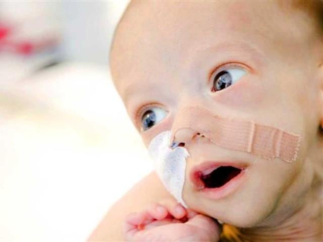 Baby hope: child survives without intestines | World News