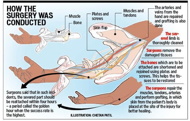 Mumbai doctors reattach severed forearm of railway worker - Hindustan Times