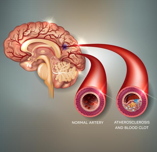 Stiffened arteries responsible for most brain injuries | Health