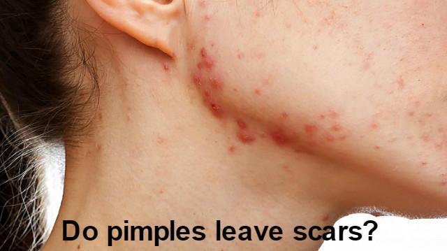 Want pimple-free face? Eight things you need to know | Health