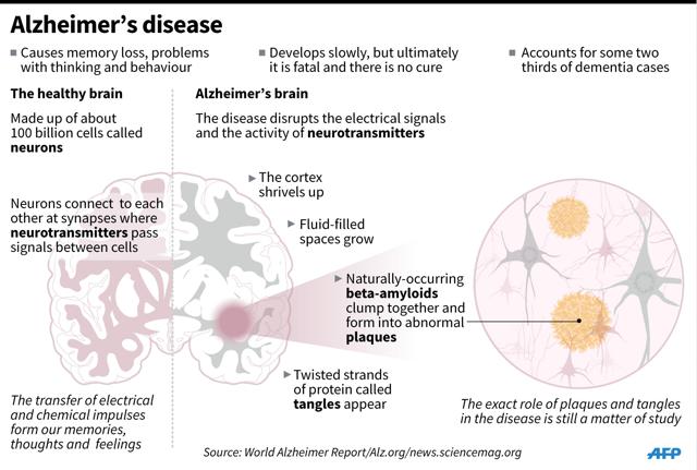 New experimental drug slows down mental decline in Alzheimer’s patients ...