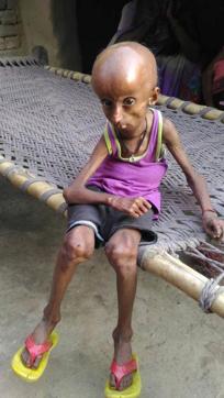 Crippled with progeria, real-life ‘Paa’ awaits aid in Allahabad village ...