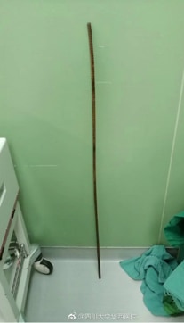 Chinese man miraculously survives after impaled by rod | World News