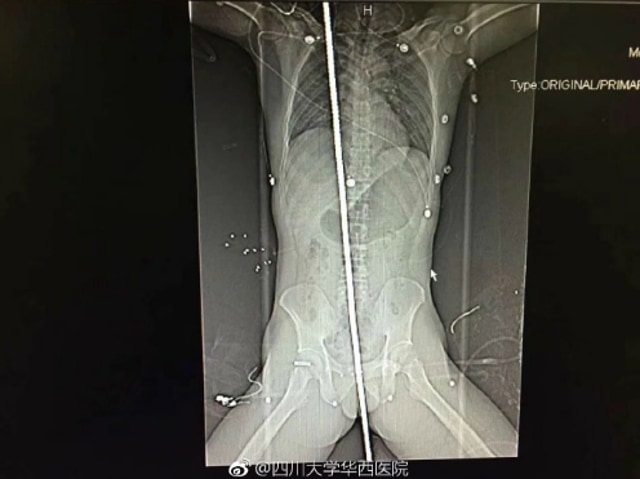 Chinese man miraculously survives after impaled by rod | World News