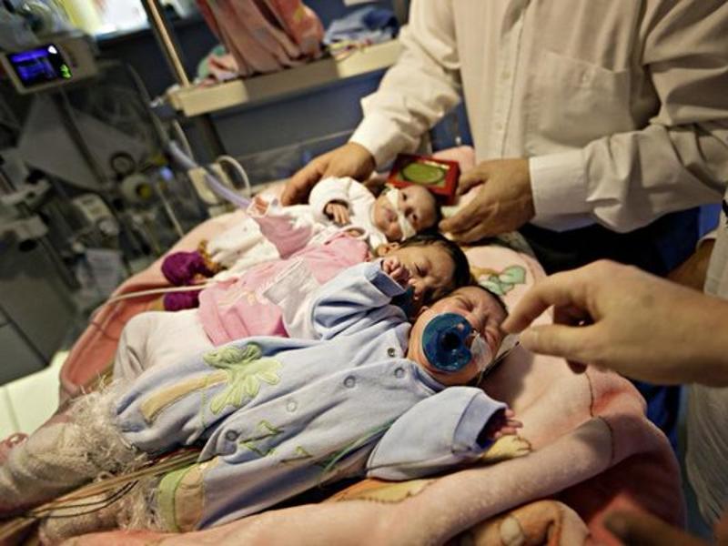 Youngest ever conjoined twins separated in Switzerland | World News