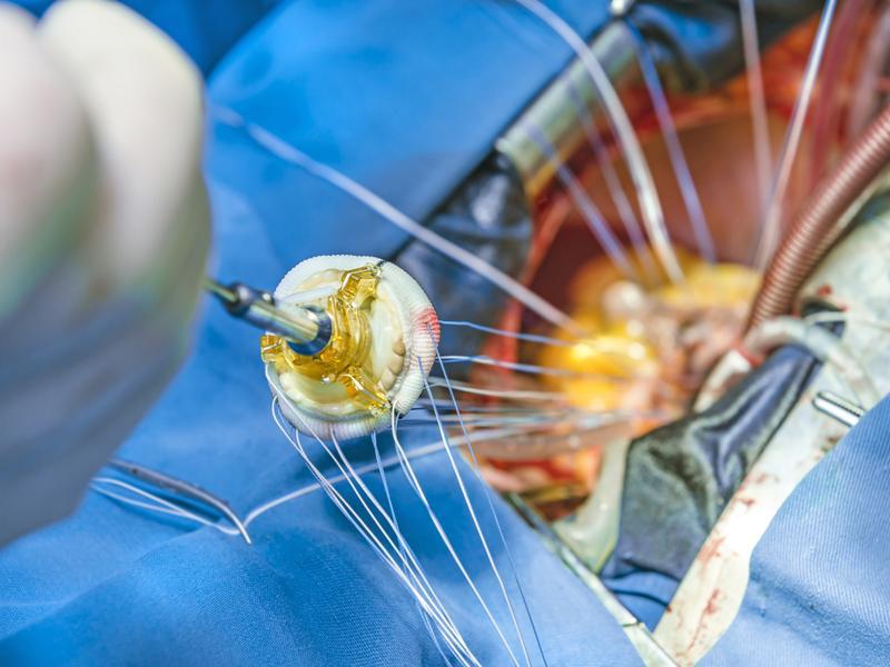 Mumbai hospital uses cow’s heart valve to save woman’s life | Latest ...