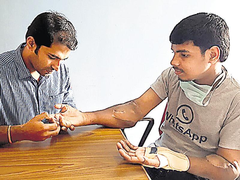 Give them a hand: 21-year-old receives India’s first twin forearm ...