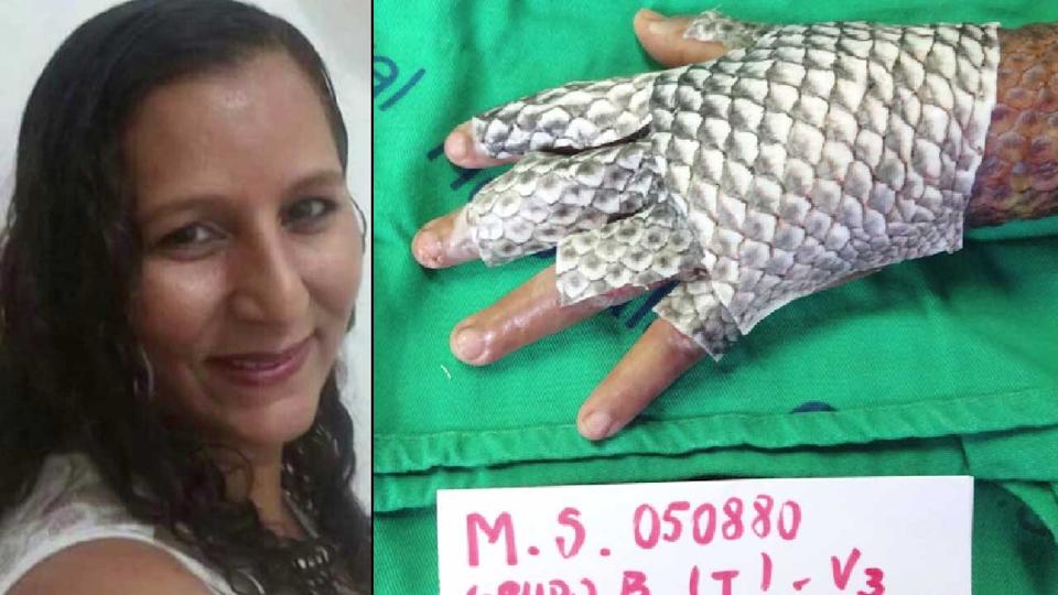 Meet | First woman to receive fish skin treatment | Hindustan Times