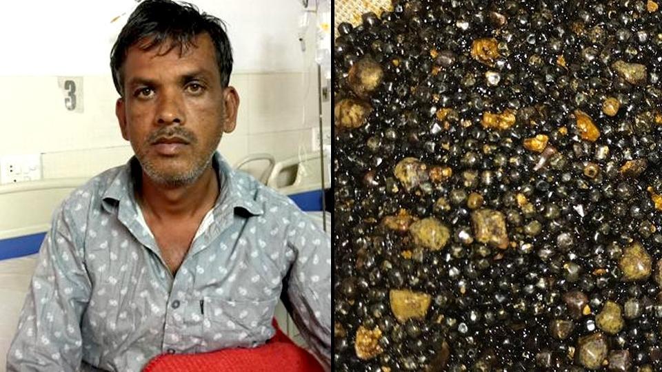 5,070 gallstones removed from Kota man: 30 minutes for surgery, 2 hours ...