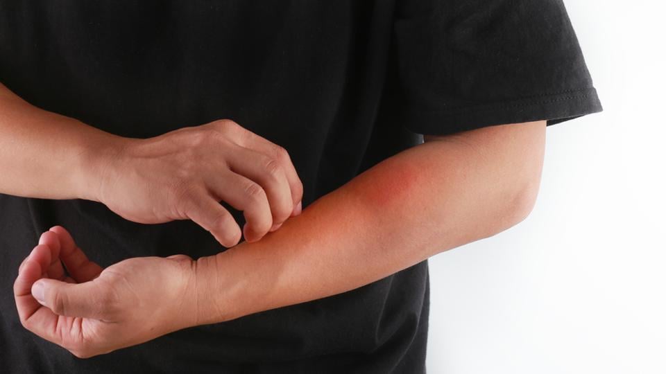 Is there a link between eczema and heart disease? Finally we have an ...