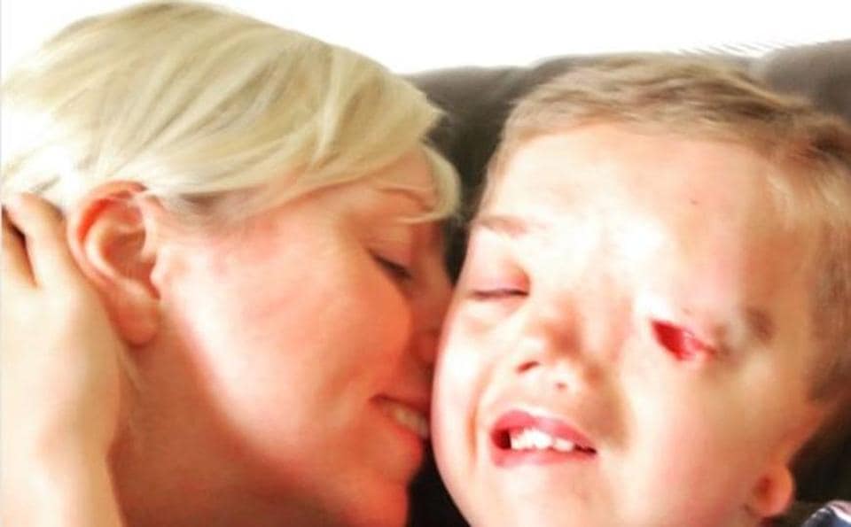 Instagram removes picture of 12-yr-old with facial disfigurement, faces ...