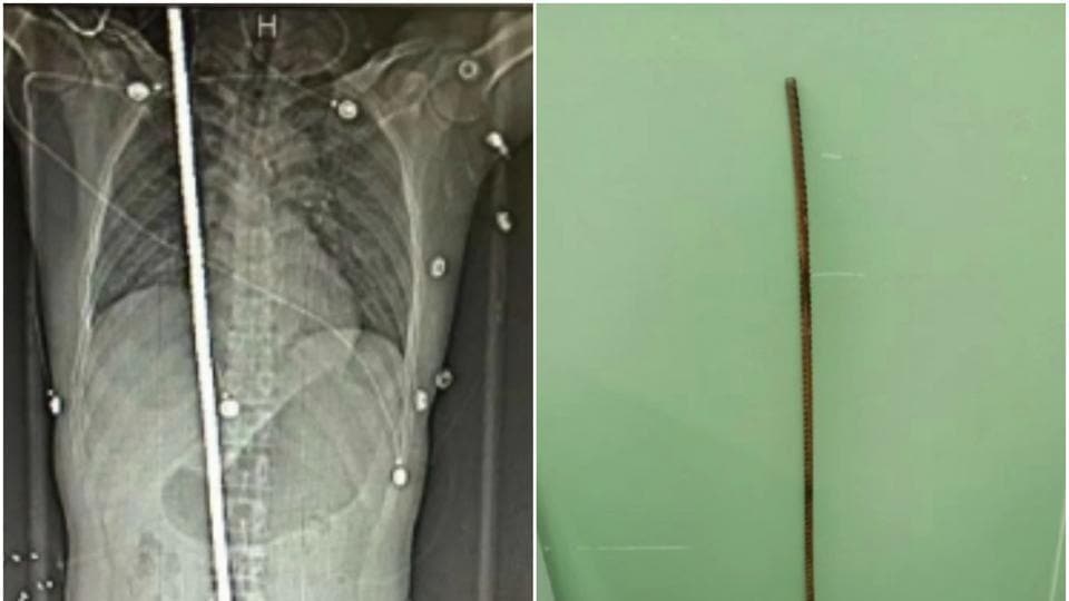 Chinese man miraculously survives after impaled by rod | World News
