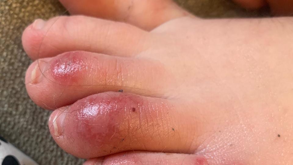Possible rare coronavirus signs include ‘Covid toes’, other rashes ...