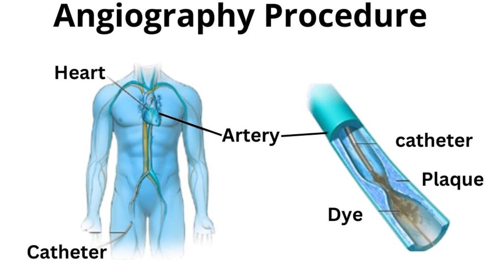 Angiogram Procedure : ஆஞ்சியோகிராம் பரிசோதனையில் உள்ள ஆபத்துகள் என்ன ...