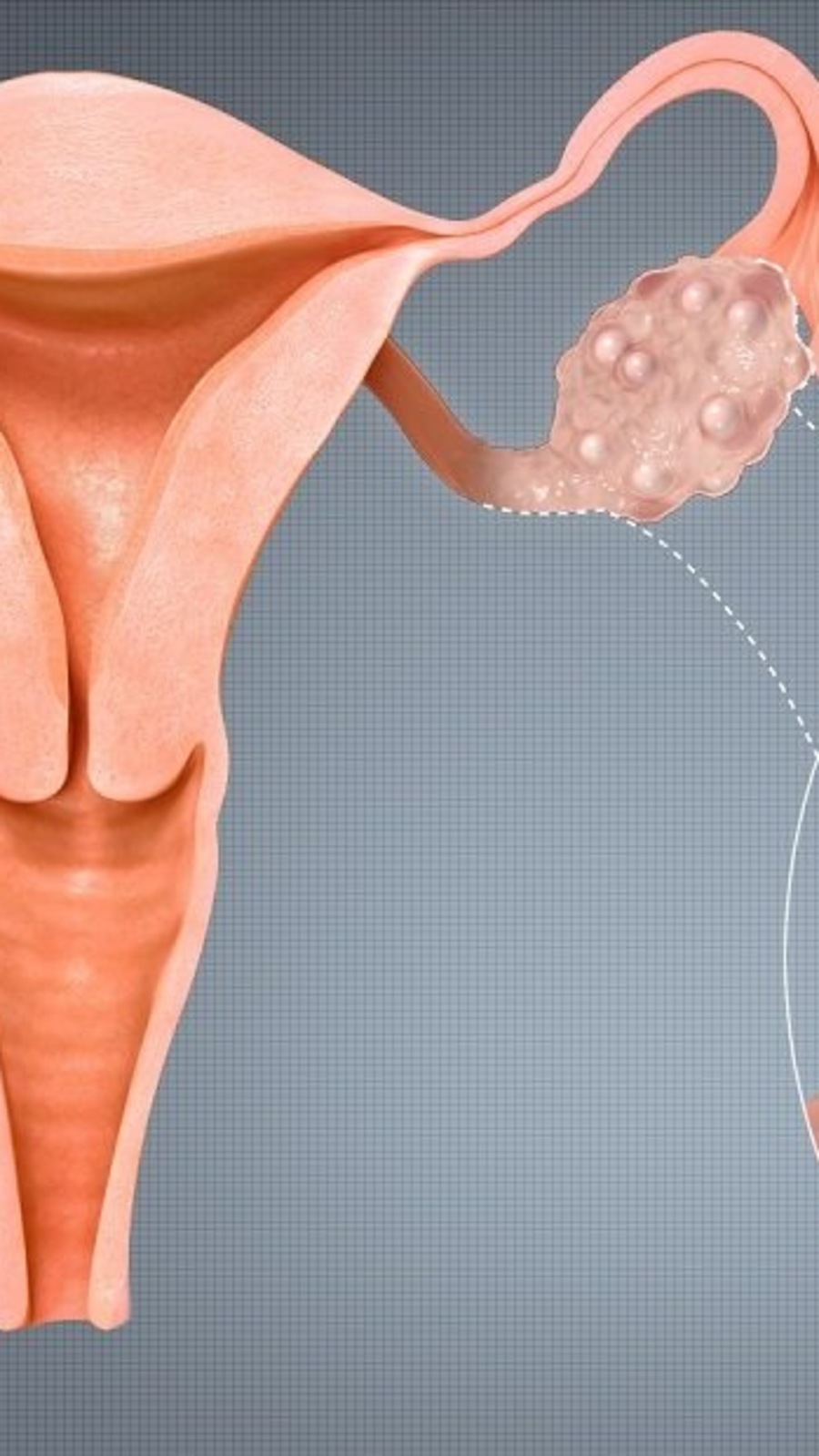 கர்ப்பப்பை நீர்கட்டிகளை கட்டுப்படுத்தும் உணவுகள்!