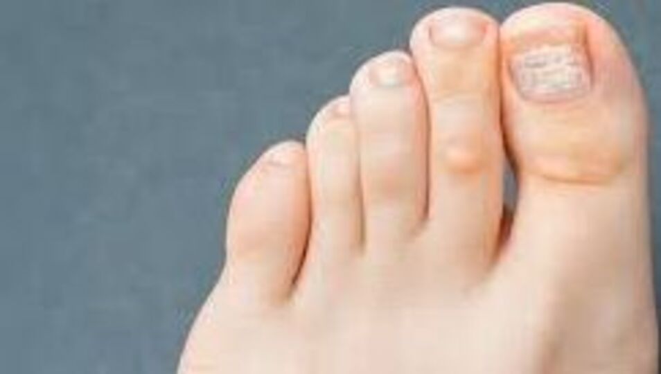 మీ గోళ్ళు తేడాగా కనిపిస్తున్నాయా? అయితే జాగ్రత్తగా ఉండండి!-toenails ...