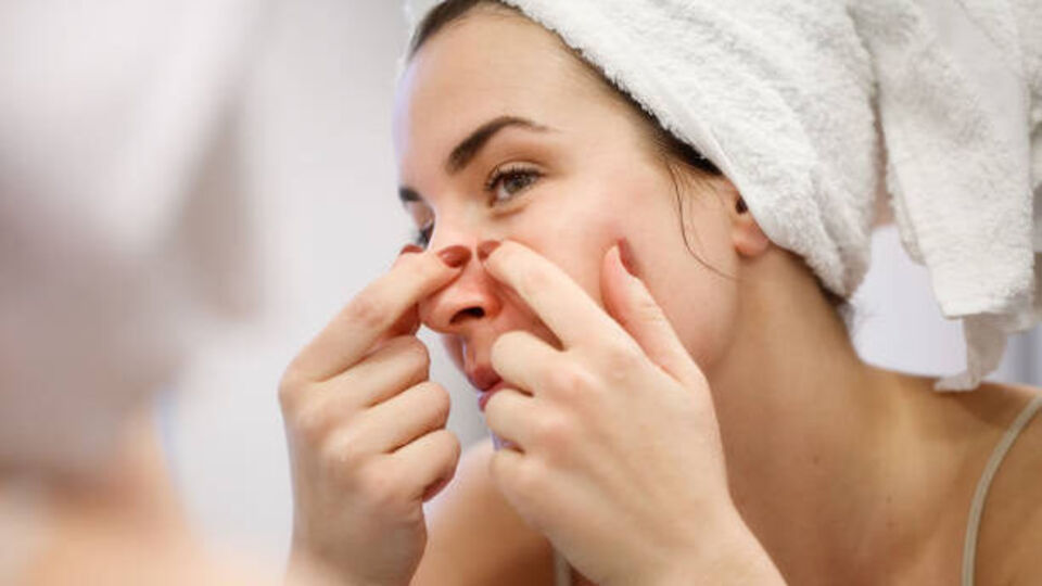 Kissing And Acne ముద్దు పెట్టుకుంటే మెుటిమలు రాకుండా ఏం చేయాలి Can You Get Acne From